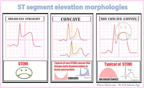 St Segment Elevation Morphologies Diagnosis Cardiology Grad