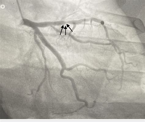 Cardiac Catheterization With Black Arrows Indicating Mid Lad Stenosis Download Scientific Diagram