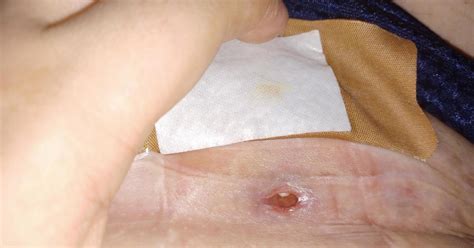 Boil Turned Abscess