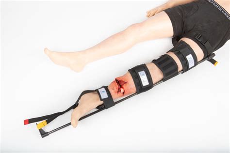 Types Of Splint Simplexplainer