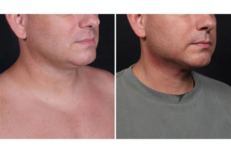 Non Surgical Neck And Jawline Contouring For Men Tampa Plastic Surgeon