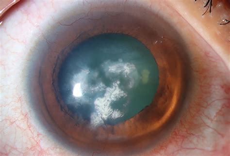 Systemic Medication Concerns For Corneas