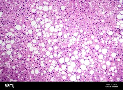 Photomicrograph Of Hepatic Steatosis Revealing Fat Accumulation In Liver Cells Known As Fatty