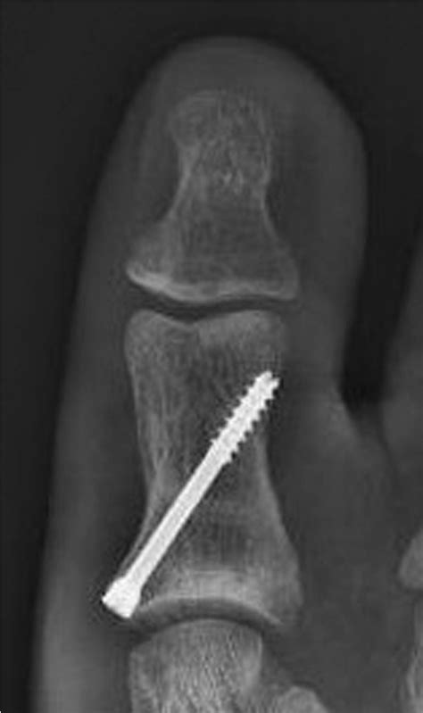 Figure 3 From Retrospective Analysis Of The Akin Osteotomy Semantic Scholar