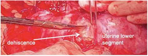 Prenatal Detection And Conservative Management Of Uterine Scar