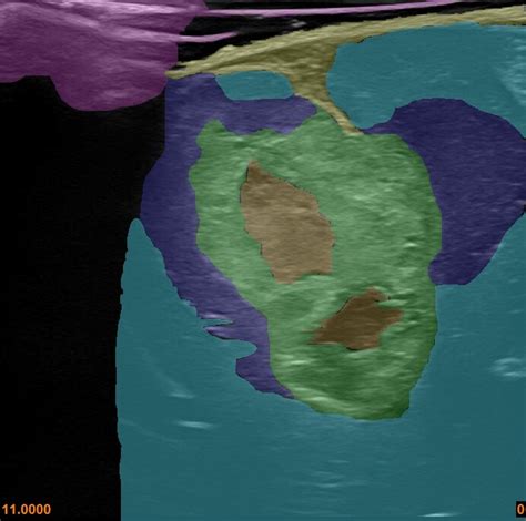 Ultrasound Segmentation Of Ius Images The Top Row Shows Suboptimal Us