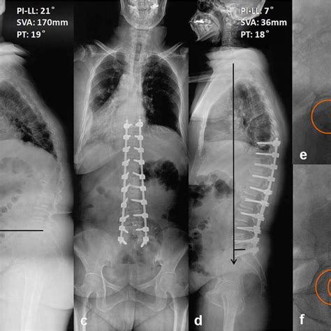 A B A 70 Year Old Female Patient With Degenerative Lumbar Scoliosis