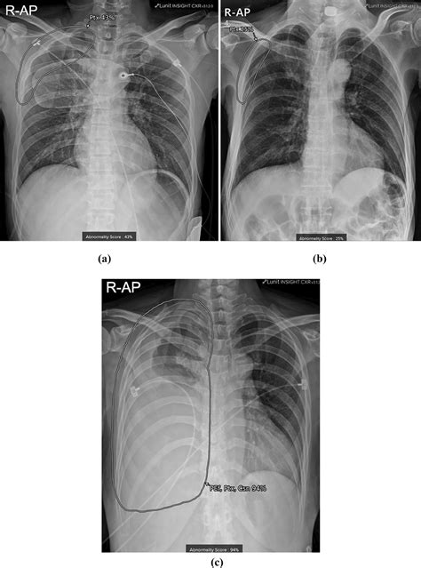 How To Identify Pneumothorax On Chest X Ray