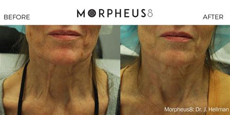 Morpheus8 Microneedling
