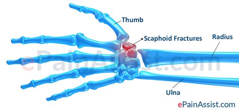 Scaphoid Fracturetypescausessymptomstreatmentphysical Therapy