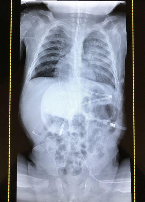 Ectopia Cordis R Radiology