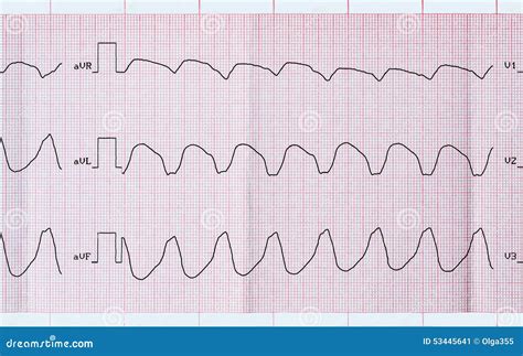 Ecg Tape With Paroxysmal Ventricular Tachycardia Royalty Free Stock