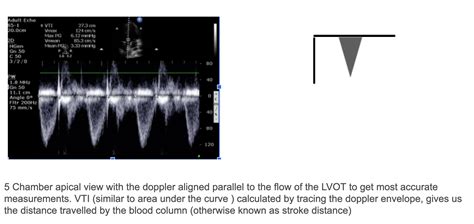 Velocity Time Integral VTI Clinical Tips For Your Patients In Shock ResusNation