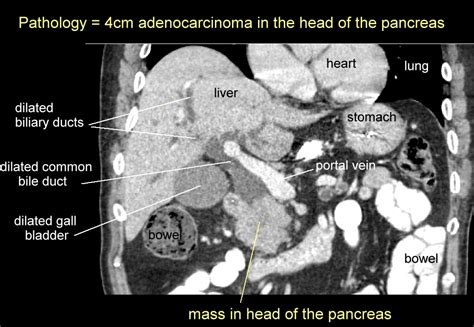 Pancreatic Anatomy Ct Radiology