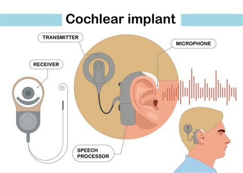 Cochlear Implant Vietnam Veteran Receives Life Altering Cochlear