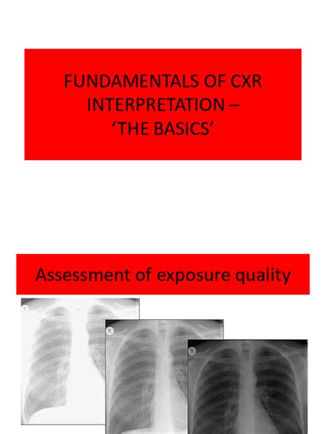 Cxr Interpretation Basics Guide Pdf