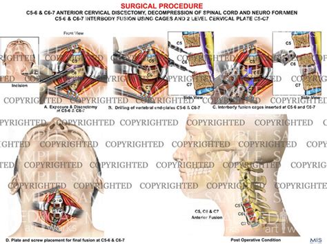 C5 6 And C6 7 Discectomy Fusion 2 Level Acd Medical Art Works