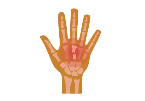 Broken Hand Signs Your Hand Is Broken And How To Treat Buoy