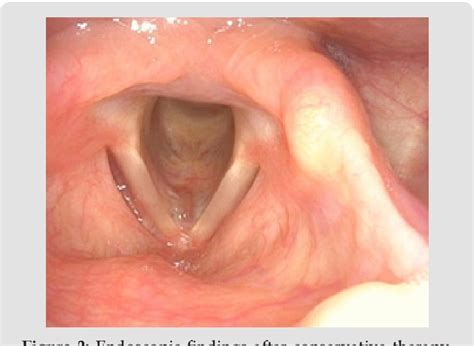 Figure 1 From A Case Of Type 2 Thyroplasty Forced To Remove The Titanium Bridge Due To Mucosal