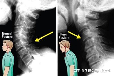 四种不同类型的颈椎病，走路像踩棉花一样属于哪一种？ 知乎