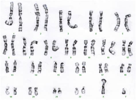 Genetic Conditions Chromosomal And Single Gene Disorders And Non
