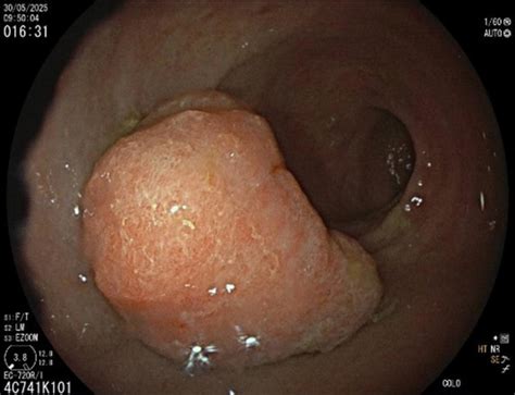 Endoscopic Zenkers Diverticulotomy Using Spydrblade Flex