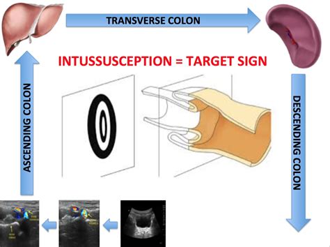Intussusception Target Sign