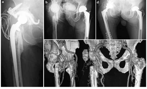 Case 2 A 74 Year Old Male With A Deep Infection After Revision Tha A