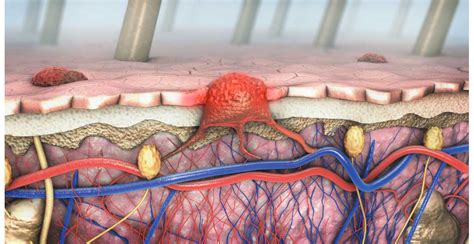 Clinical Management Of Advanced Skin Cancer Dermatology In Practice
