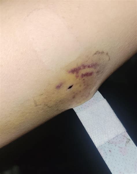 Implant Insertion Left Me A Hole Help Rnexplanon