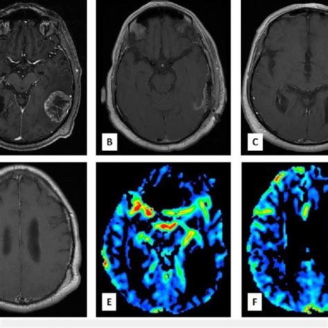 Scalp Metastasis Post Craniotomy And Radiosurgery A D Gadolinium Download Scientific Diagram