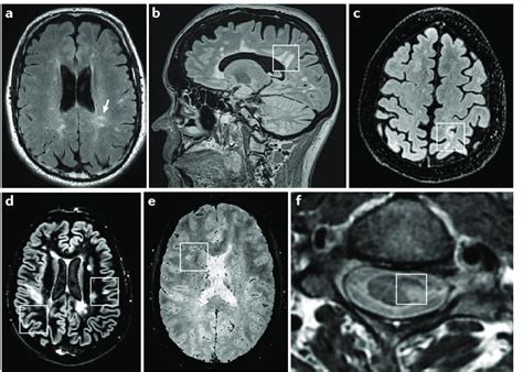 Multiple Sclerosis Mri Diagnosis