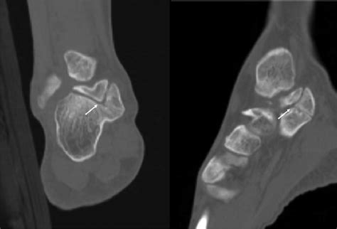 Computed Tomography CT Scan Of The Ossicle Oblique Coronal CT A