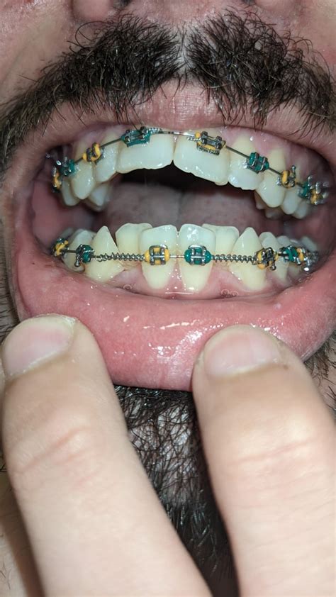 Just Got Open Coil Springs Curious About How They Work Or If Mine Were