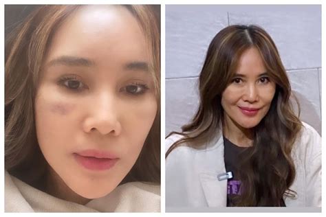 Kini Tampak 20 Tahun Lebih Muda Ini 5 Potret Beda Ina Thomas Sebelum Dan Sesudah Operasi Plastik