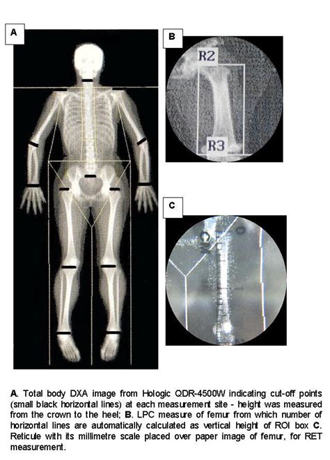 A Method For Determining Skeletal Lengths From Dxa Images Bmc Musculoskeletal Disorders Full
