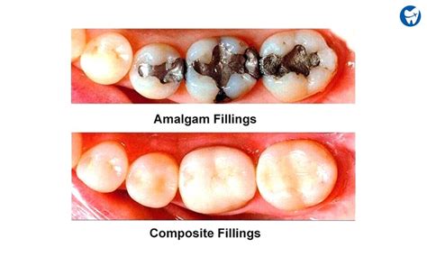 Cavity Before And After Filling