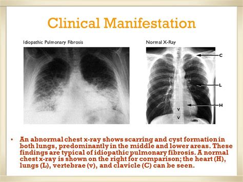 Pulmonary Fibrosis