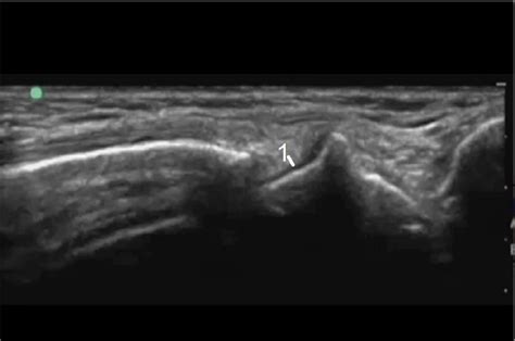 Wrist Radioscaphoid Recess Injection 2 Image Sonosite Institute For Point Of Care Ultrasound