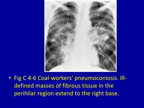 4 Diffuse Reticular Or Reticulonodular Pattern Pptx