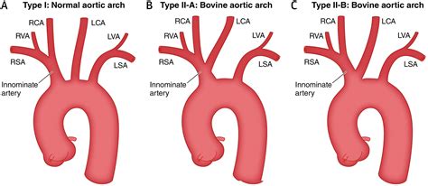 Aortic Arch Anatomy Variants