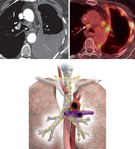 Pleural Tumors Clinical Tree
