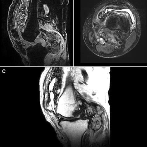 Mri Of The Knee Motion Artifacts A T1 Weighted Vibe Sagittal