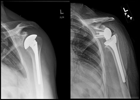Reverse Total Shoulder Replacement X Ray At Maria Spillman Blog