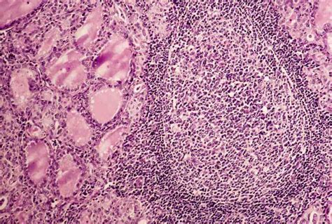 Thyroid Pathology Pathology Student