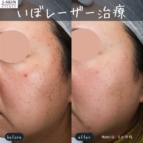 顔 ざらざま 治し方 顔の肌が急にざらしざらする 肌のザラザラをなんとかしたい！顔のざらつきを改善させる方法 Jloxso