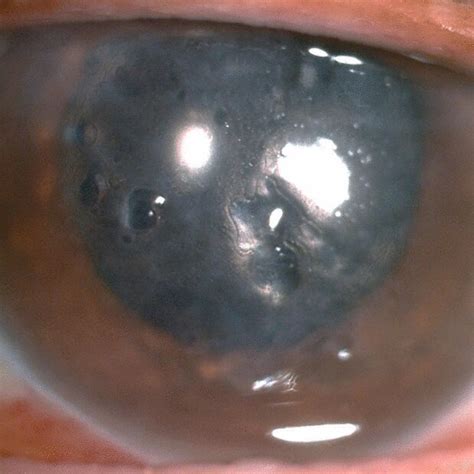 Corneal Indentation Ci In Eyes With Diffuse Corneal Edema A Eye