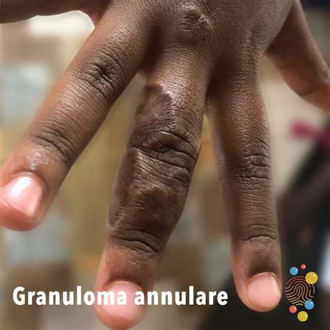Granuloma Annulare Skin Deep