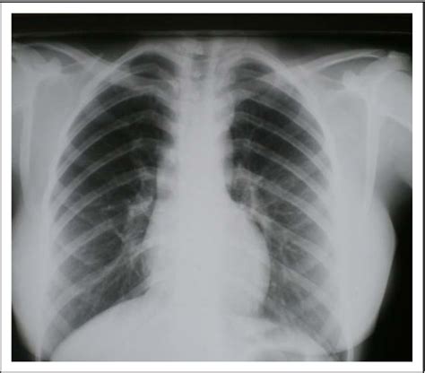 Figure 1 From Cervical Arch With Aortic Kinking Semantic Scholar