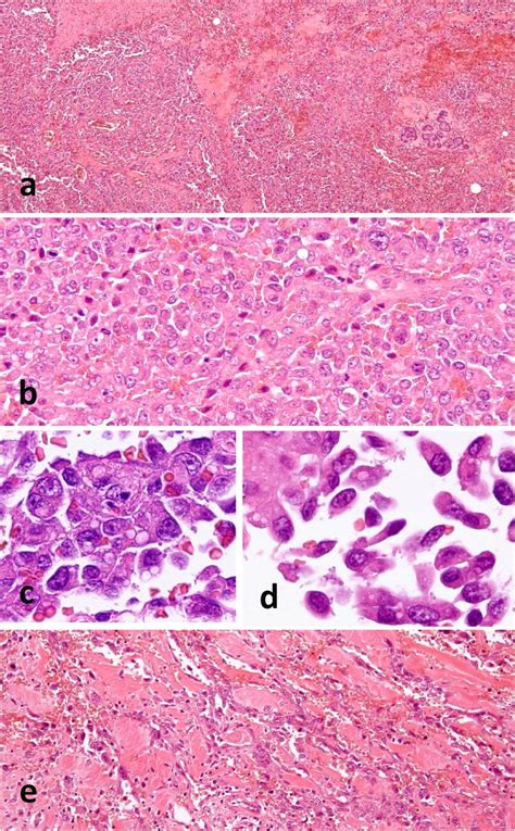 Epithelioid Angiosarcoma Of The Parotid Area A Case Report With